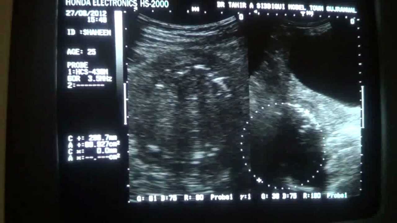 uterine FIBROID with numerous internal calcifications - YouTube