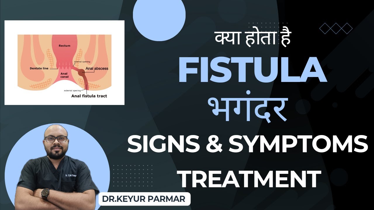 WHAT IS FISTULA SIGNS SYMPTOMS TREATMENT IN HINDI WHAT IS FISTULA SIGNS SYMPTOMS TREATMENT IN HINDI