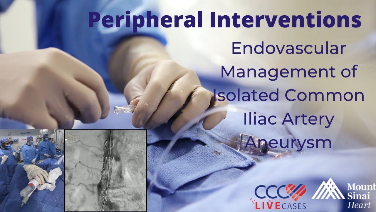 Endovascular Management of Isolated Common Iliac Artery Aneurysm - YouTube