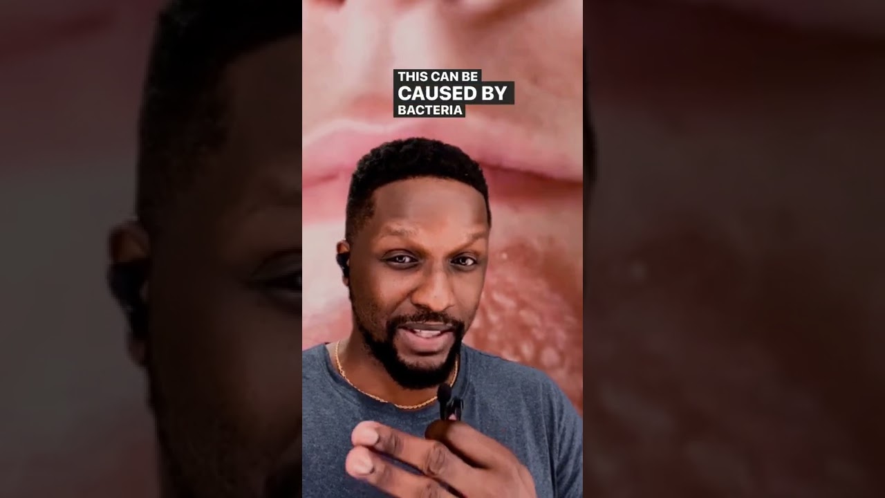 Skin Infection From a KISS | Beard Burn | Impetigo - YouTube