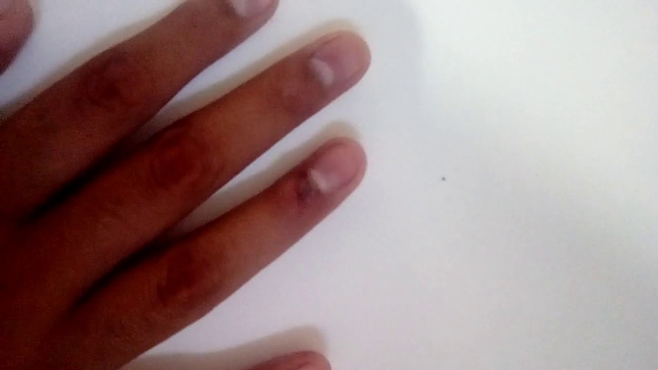 video do meu dedo machucado 😔 - YouTube