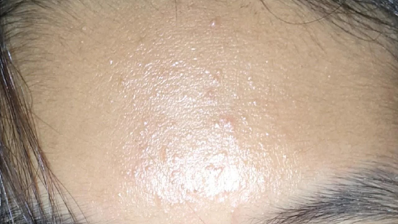 how to get rid of closed comedones on forehead naturally - YouTube