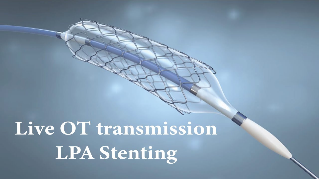 Live OT transmission LPA stenting - YouTube