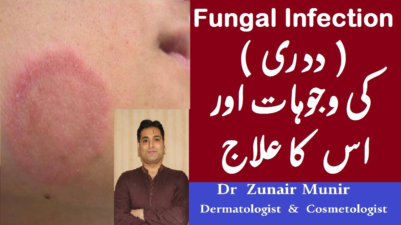 Fungal Infection Dadri Ka Ilaj In Urdu Dadri Ka Ilaj Dadri Ka fungal-infection-dadri-ka-ilaj-in-urdu-dadri-ka-ilaj-dadri-ka