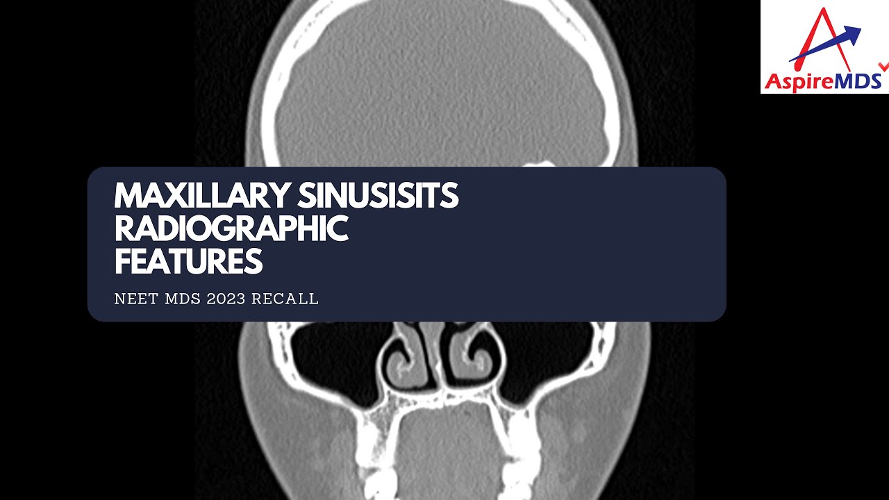 Radiographic Features of Maxillary Sinusitis - Recall from NEET MDS ...