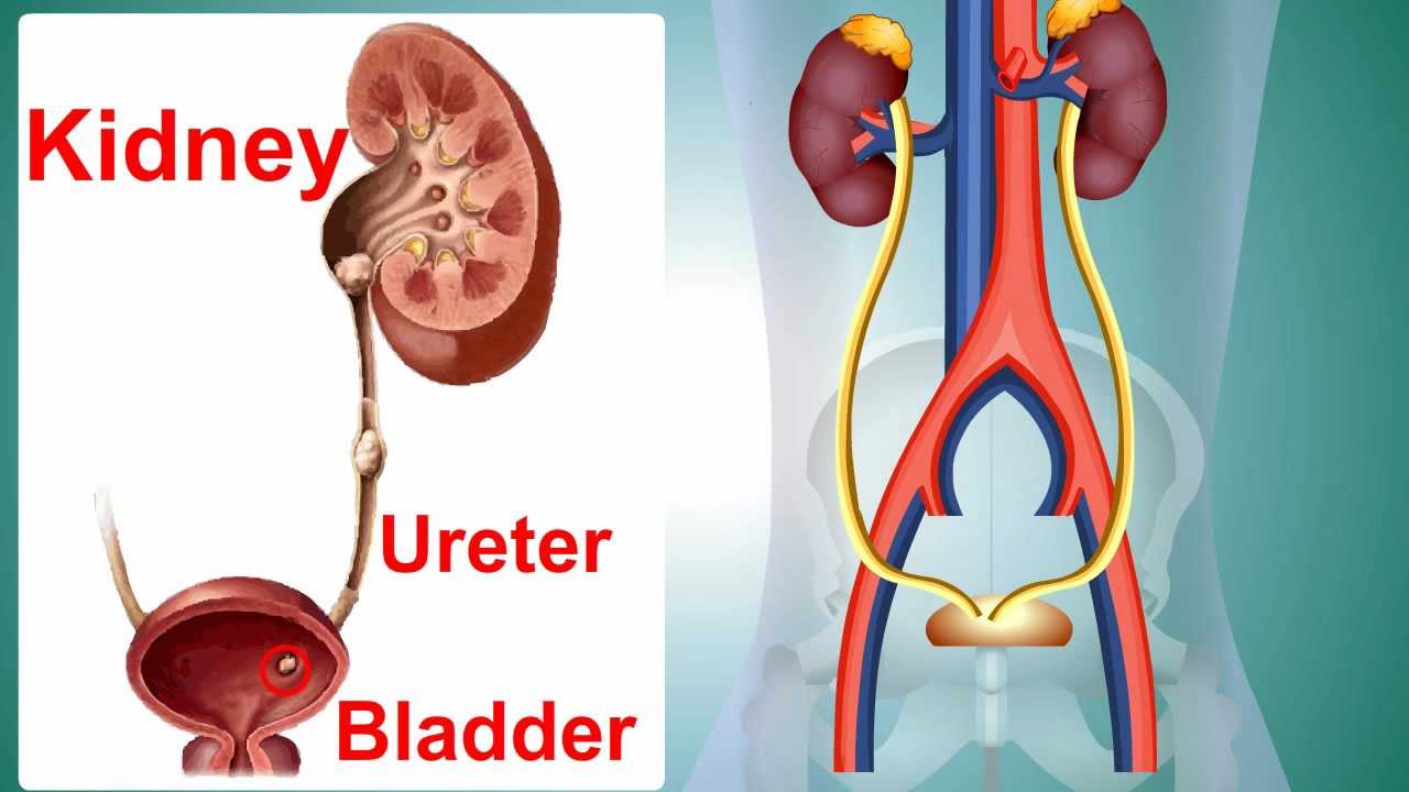 Kidney Stone Or Calculus YouTube