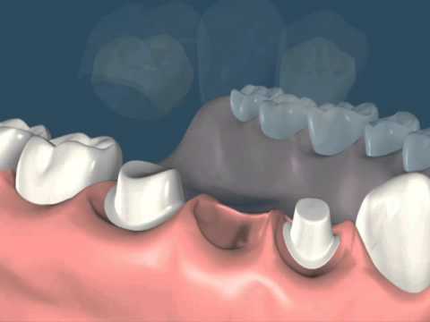 preparo para ponte fixa - YouTube