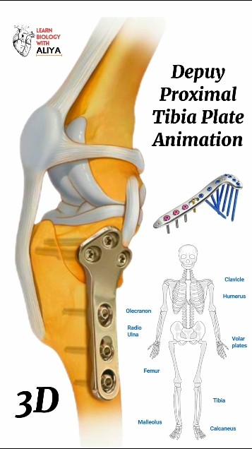 Depuy Proximal Tibia Plate - Animation | #3d #short - YouTube
