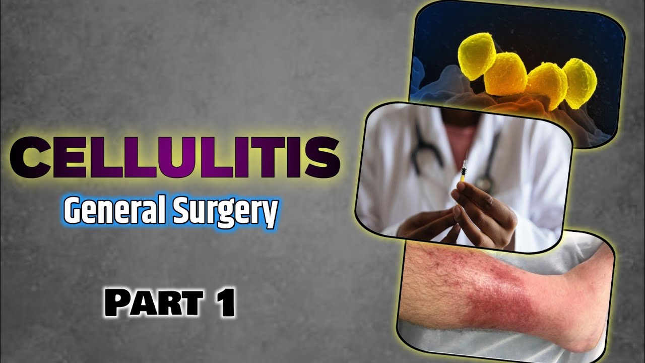 CELLULITIS | General Surgery | In HINDI | PART 1 | In Detail | For 10 ...