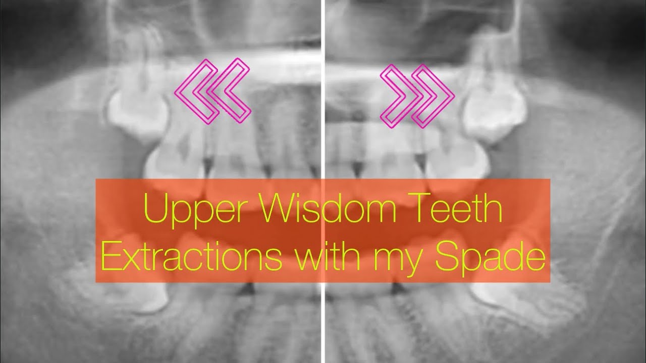 Upper Wisdom Teeth Extractions Using a Spade @drwahan - YouTube