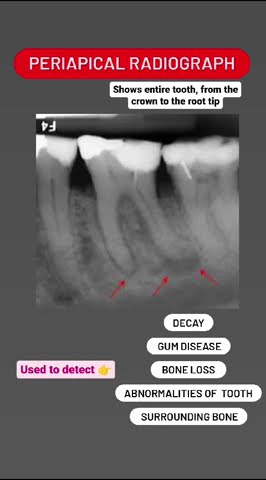 what is a periapical radiograph (IOPA) ??? - YouTube