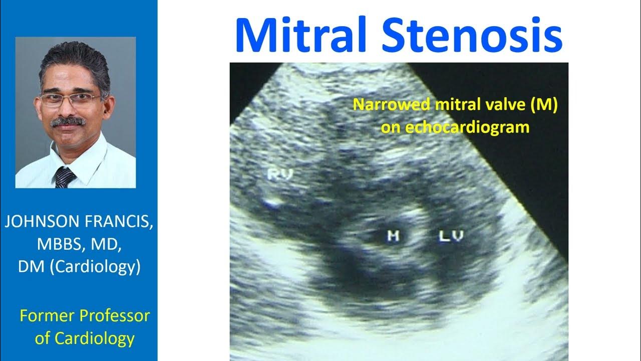 Mitral Stenosis Youtube