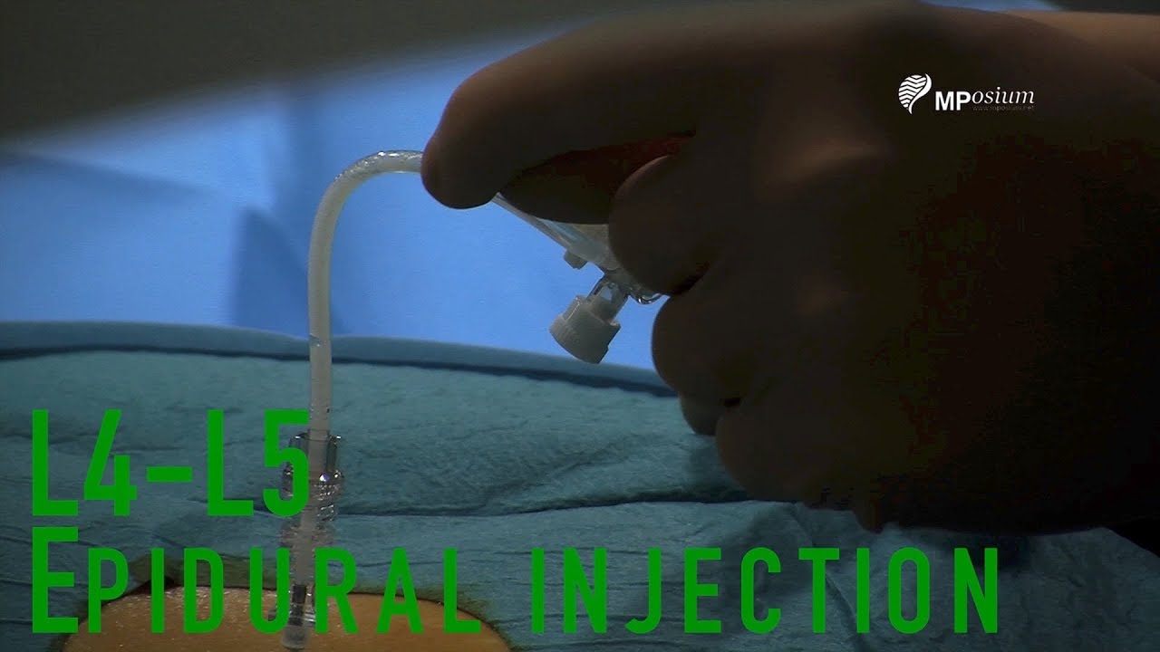 L4-L5 epidural injection - YouTube