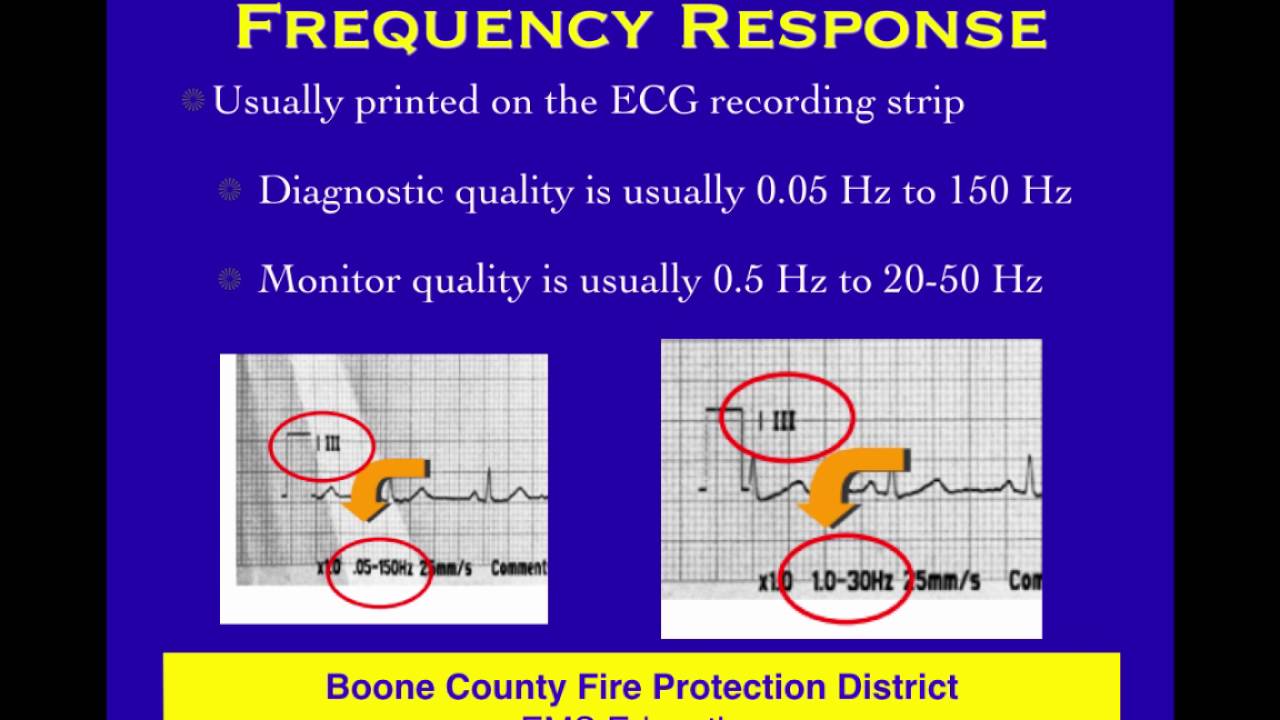 ECG 30 Diagnostic Quality - YouTube
