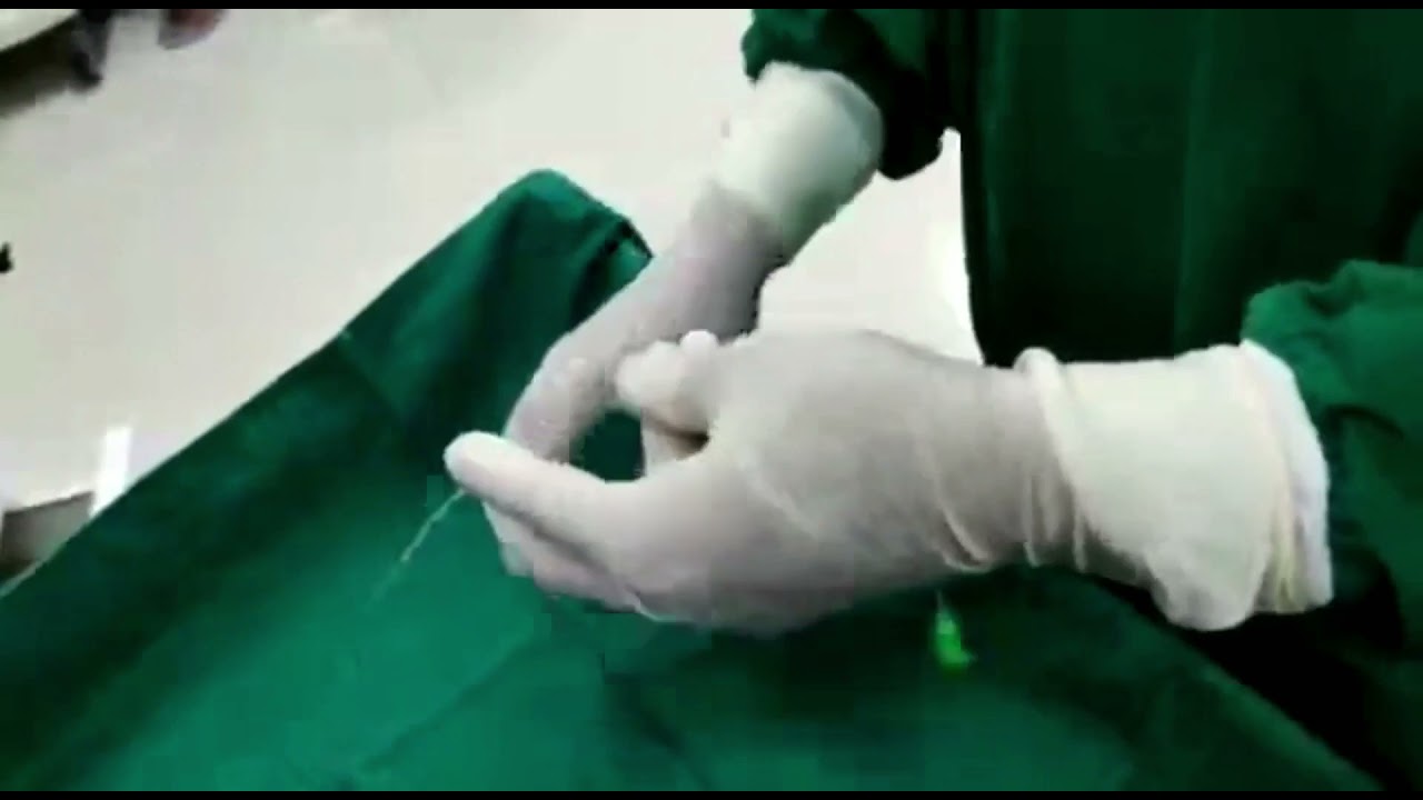 LISA or MIST: SURE technique for surfactant delivery via thin catheter ...