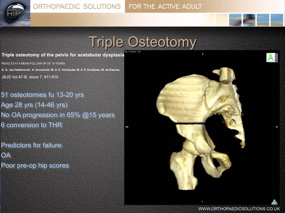 acetabular osteotomies - YouTube