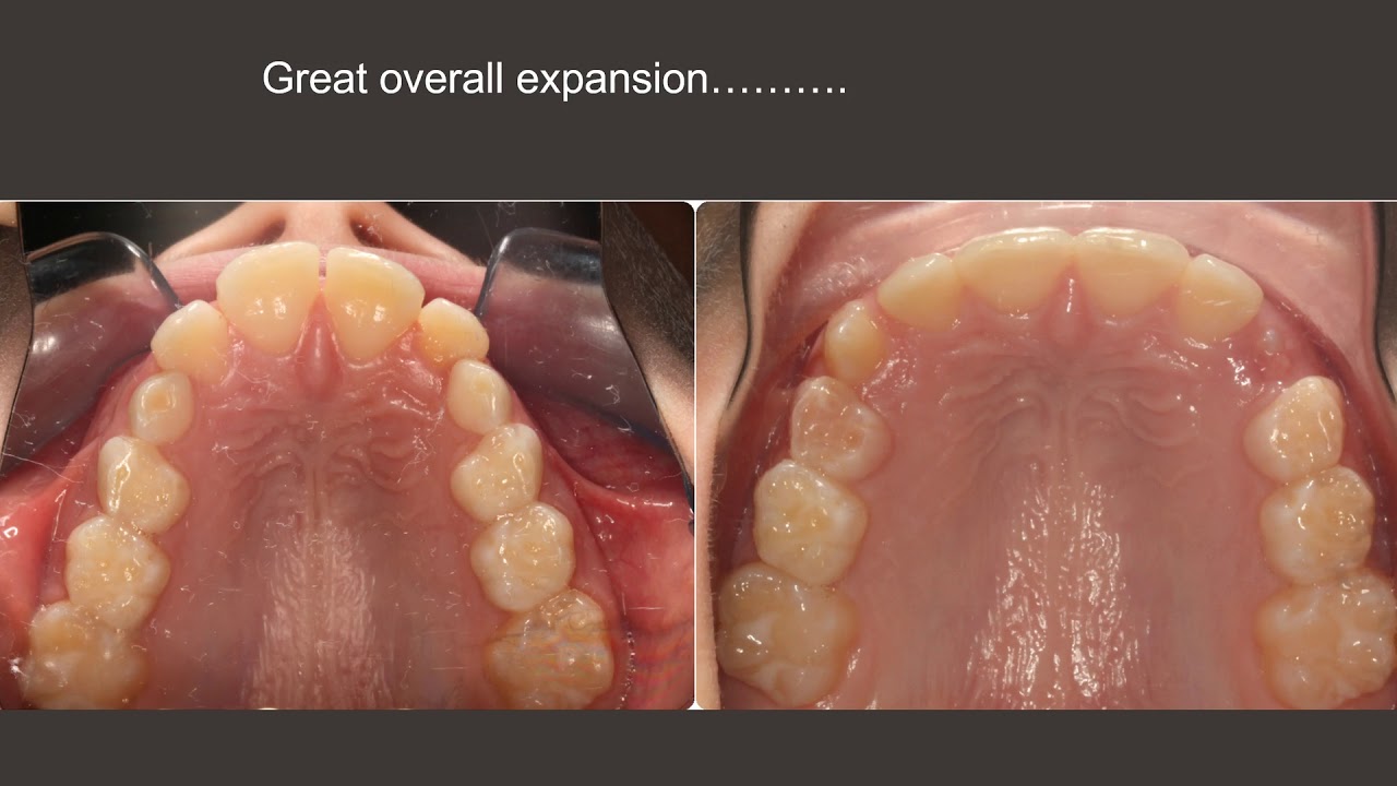 Quick Tip - Invisalign First Indications and Treatments - YouTube