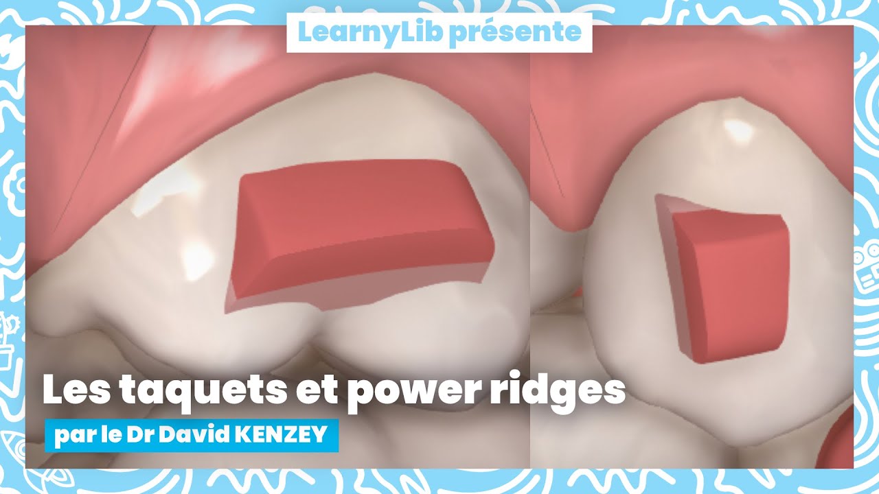 🦷 Les aligneurs en omnipratique : les taquets et power ridges avec le ...