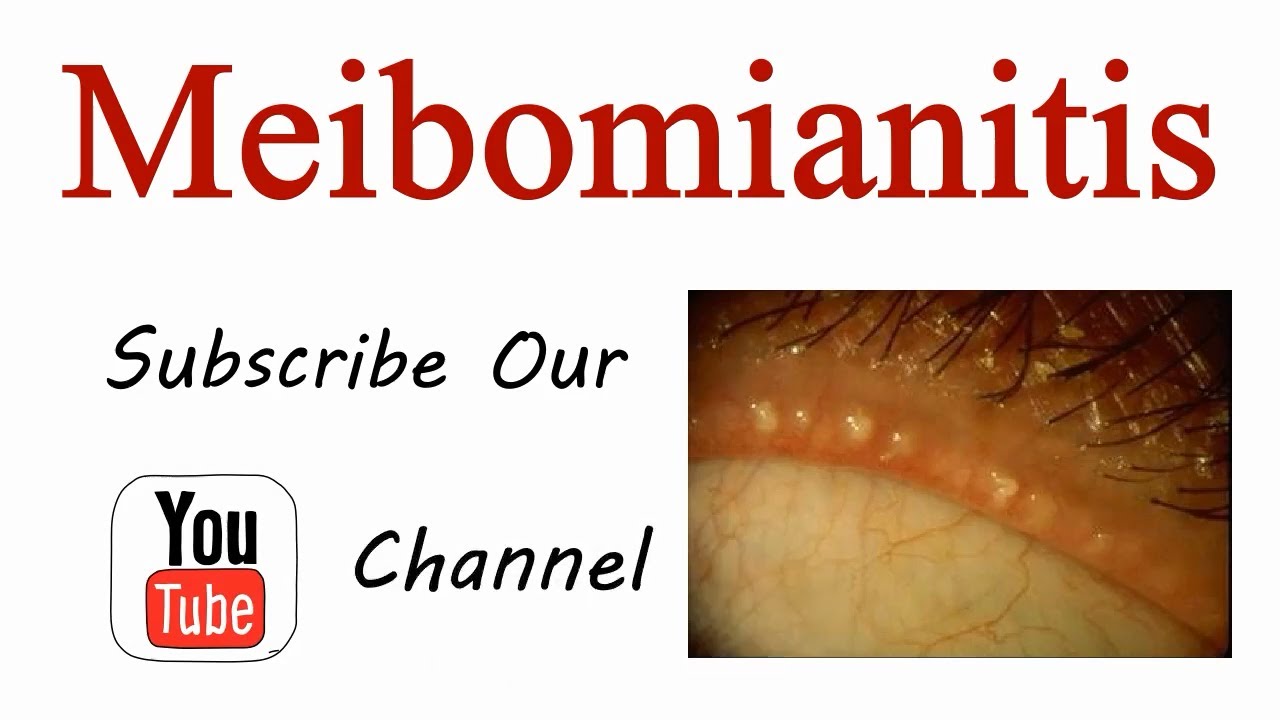 Meibomianitis - A diseases of Meibomian Glands - Ocular Disease ...