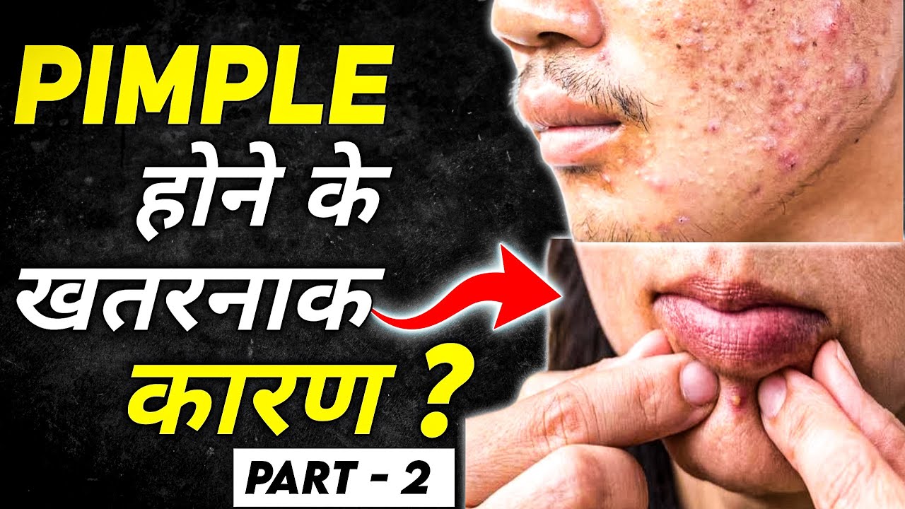 इसलिए आपको पिंपल होते हैं | pimple hone ke khatarnak karan ? - YouTube