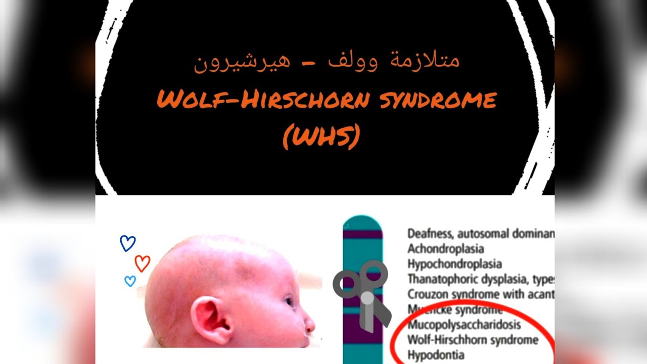 Wolf - Hirschhorn Syndrome (WHS) (In English) - YouTube