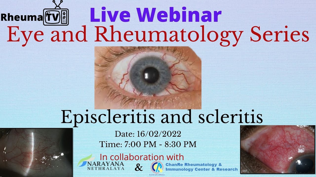 Scleritis Vs Episcleritis