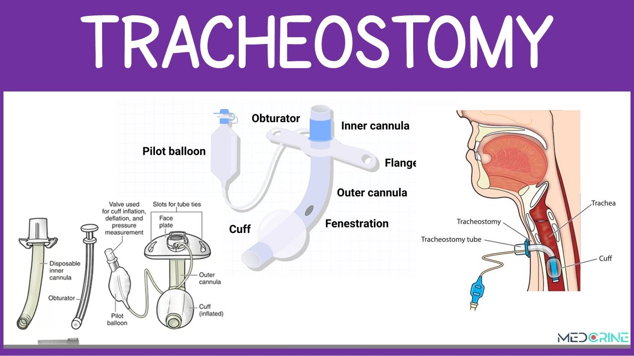 Tracheostomy Tubes: Types, Components, Nursing and Respiratory care ...