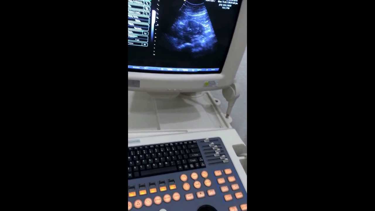 Medison Sonoace 8000 Live - YouTube
