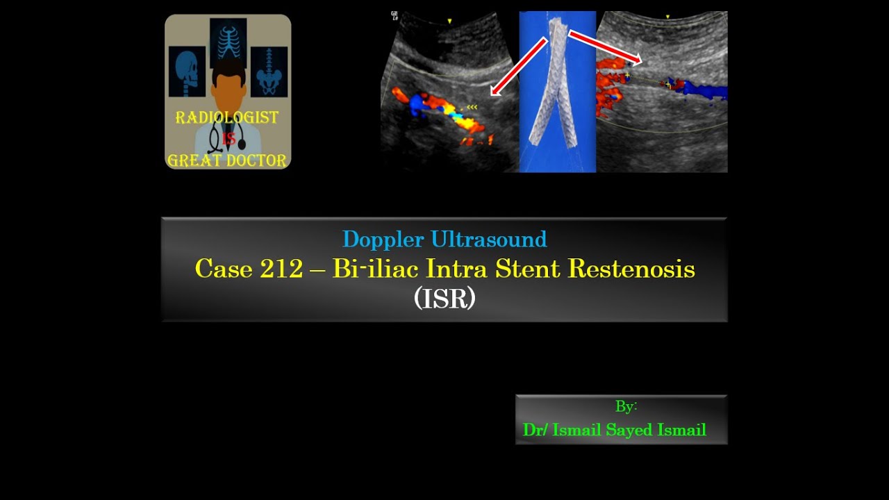 Ultrasound Case 212 - Bi-iliac Intra-Stent Restenosis (ISR) - YouTube