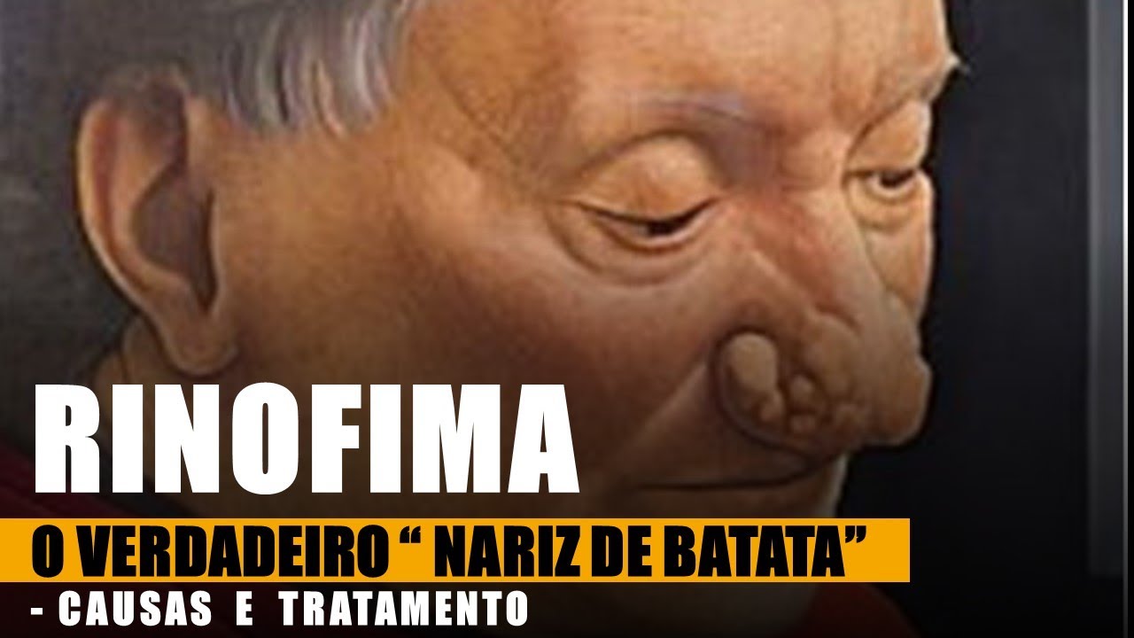Rinofima - tratamento e resultados. - YouTube
