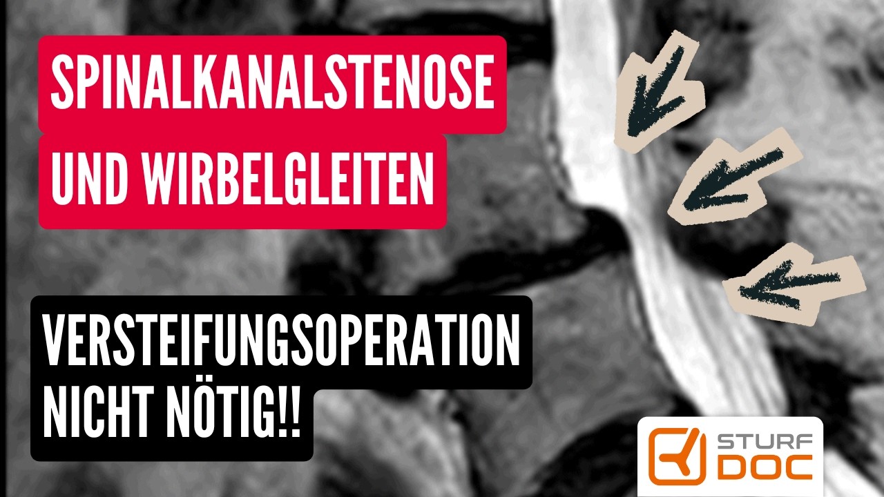 Spinalkanalstenose und falsches Wirbelgleiten (Pseudospondylolisthese ...