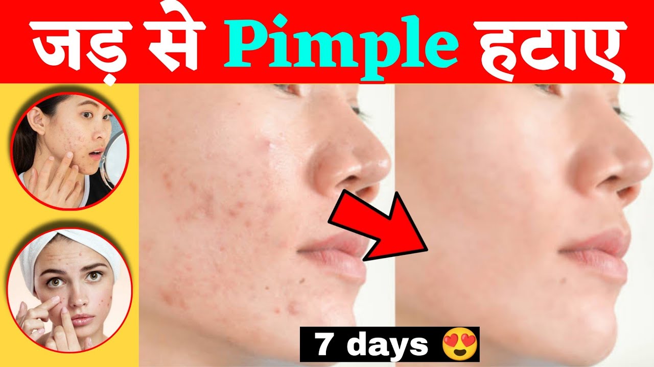 Pimple free skin chahte hai to ye video jarur dekhe | how to get pimple ...