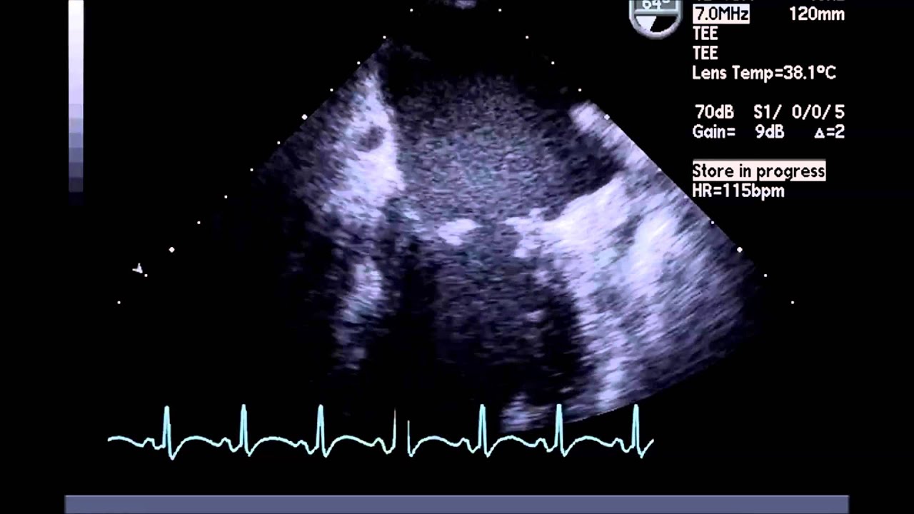TEE SevereMR Endocarditis - YouTube
