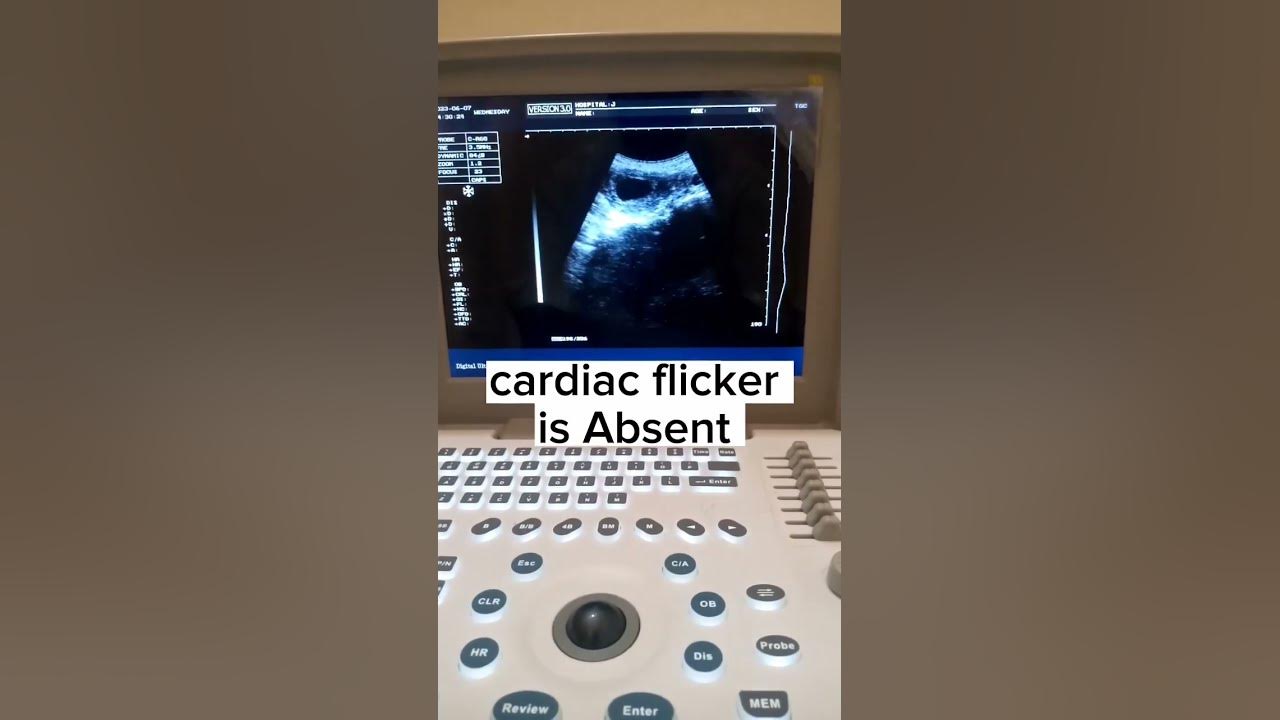 8 Weeks Fetus Cardiac Flicker I Absent Ultrasound Of FWB YouTube 8-weeks-fetus-cardiac-flicker-i-absent-ultrasound-of-fwb-youtube