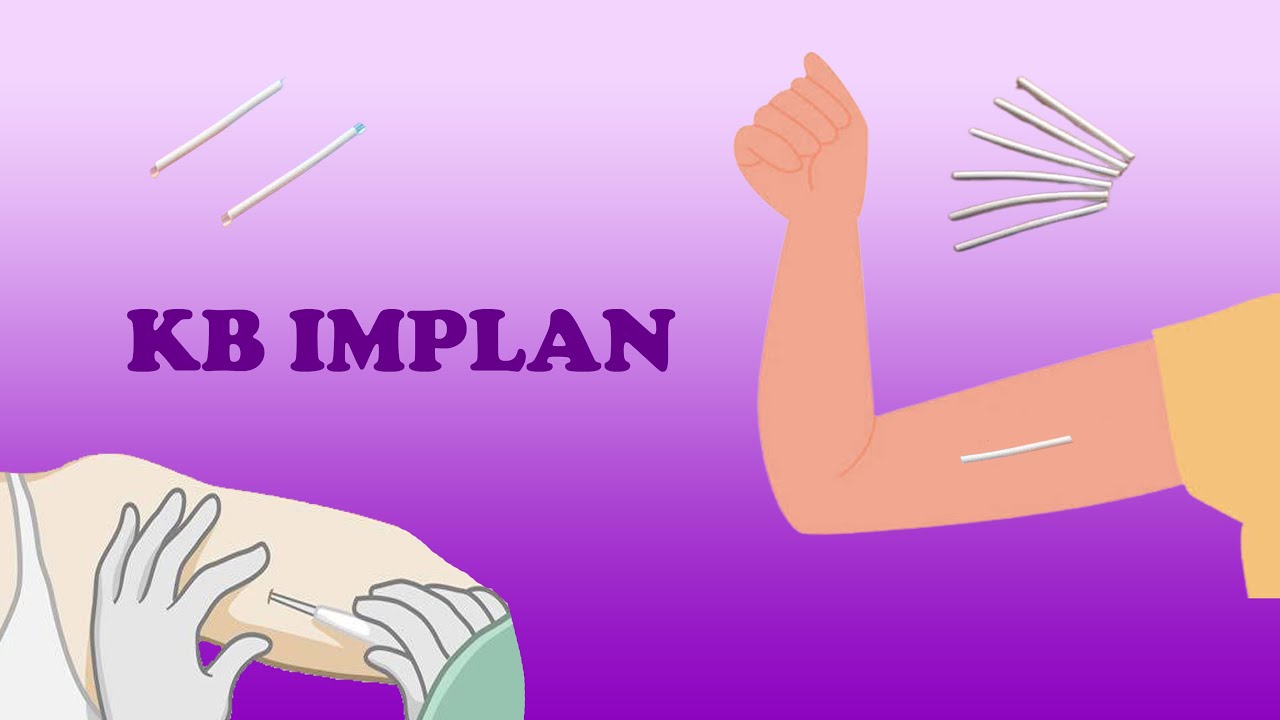 KB / Kontrasepsi Implan (Susuk) - YouTube