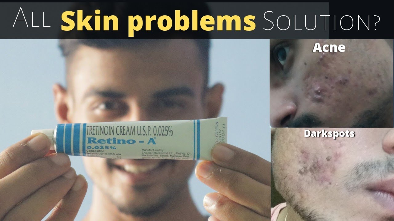 Tretinoin Cream Full Review Remove Darkspots And Acne Scars Youtube