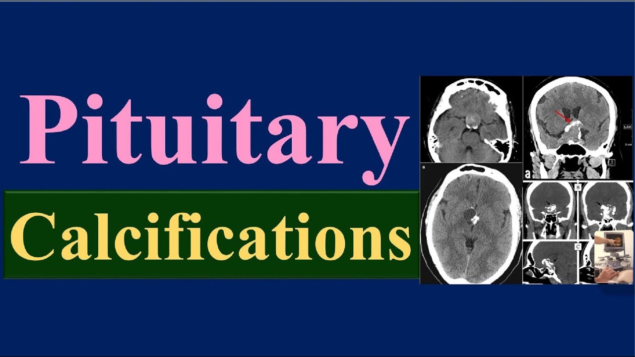 Understanding Pituitary Calcifications In Depth NOW - YouTube