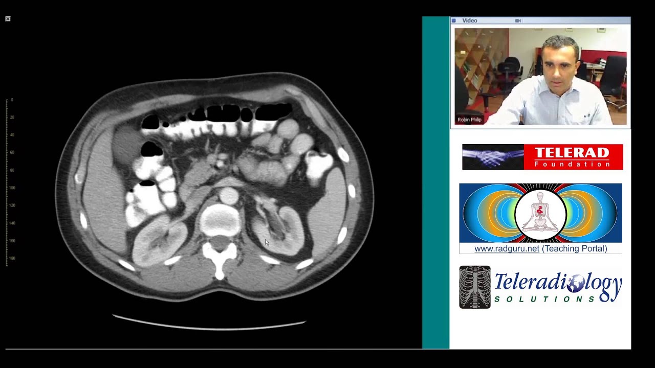 CT of Perforated Sigmoid Diverticulitis by Dr Arjun Kalyanpur - YouTube