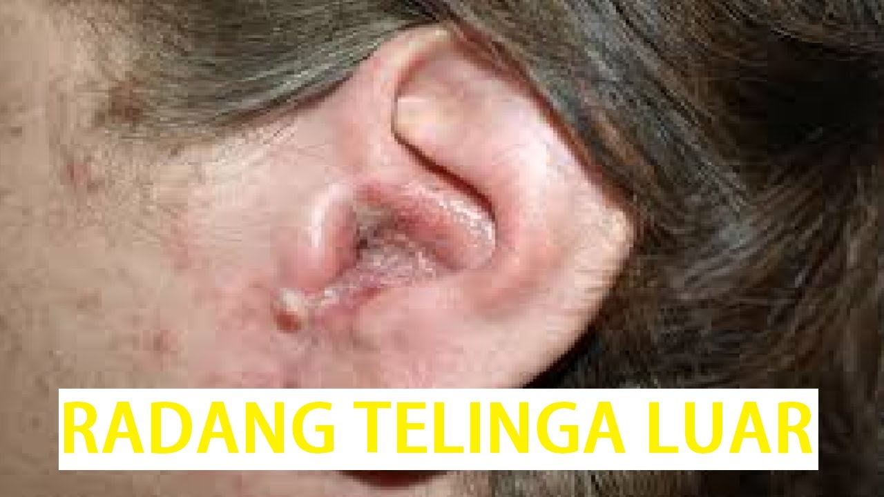 Radang Telinga | Akibat Mengorek Telinga | Otitis Eksterna | Trauma ...