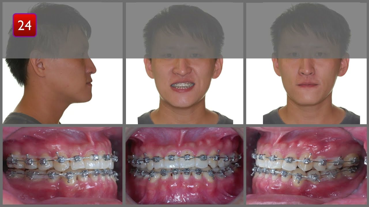 Severe Skeletal Class III Correction With Class III Elastics Bite severe-skeletal-class-iii-correction-with-class-iii-elastics-bite
