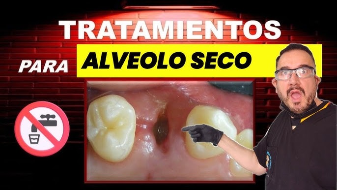Alveolo Alveolar
