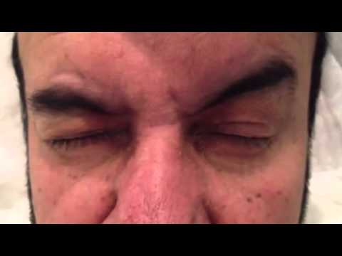Apraxia of lid opening - YouTube