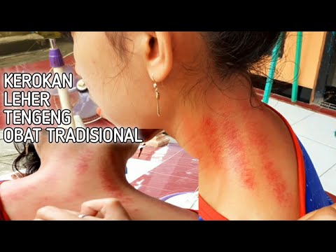 KEROKAN LEHER TENGENG OBAT TRADISIONAL || NARIN PEZZEK - YouTube