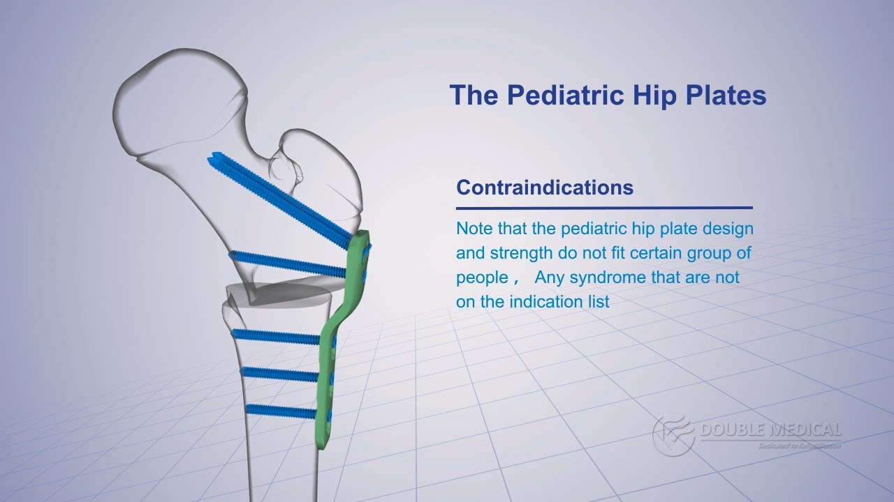 Double Medical Pediatric Hip Plate - YouTube