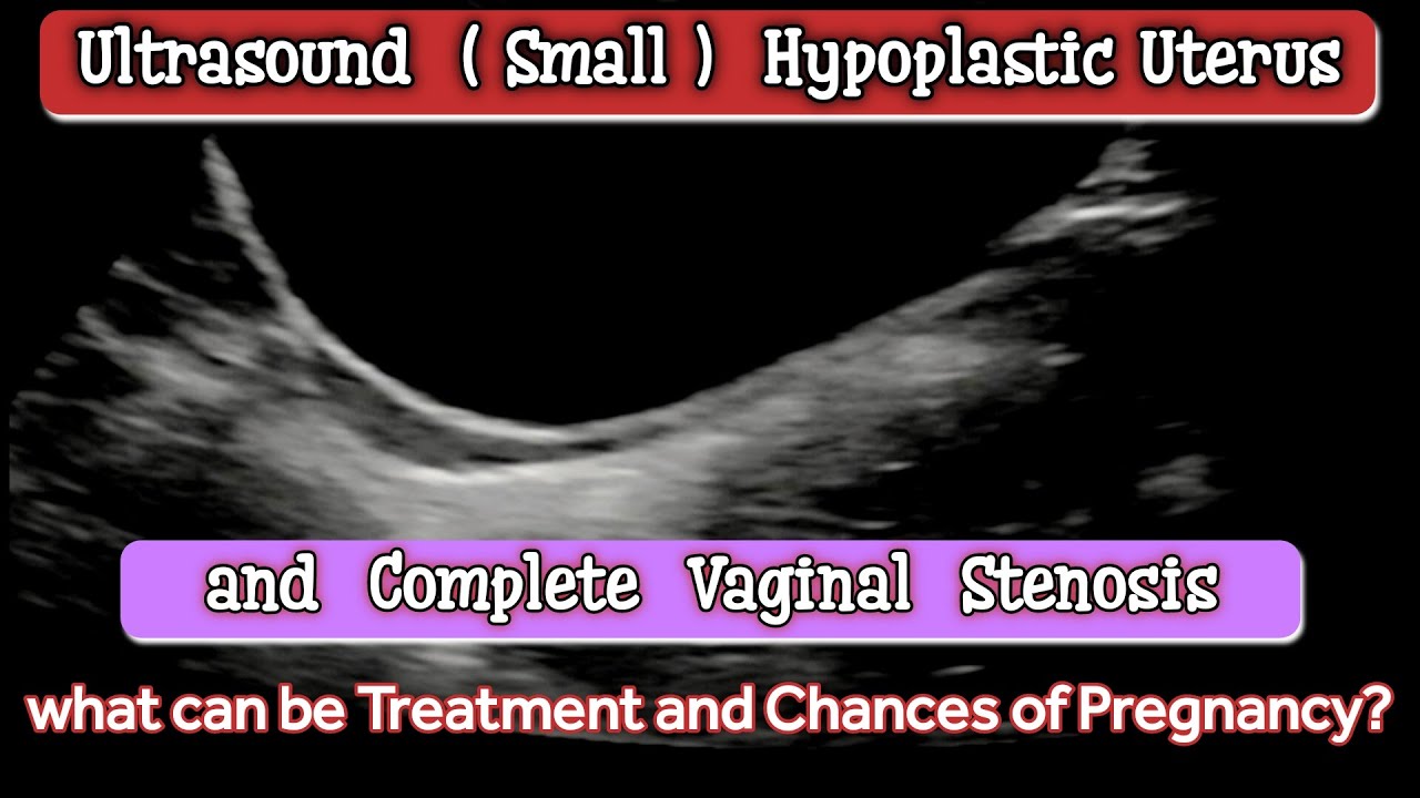 Ultrasound Small Hypoplastic Uterus And Vaginal Stenosis Youtube