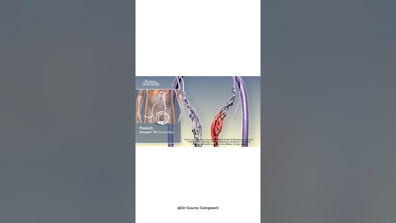 Non Surgical Treatment Of Varicocele 3d Animation Varicocele