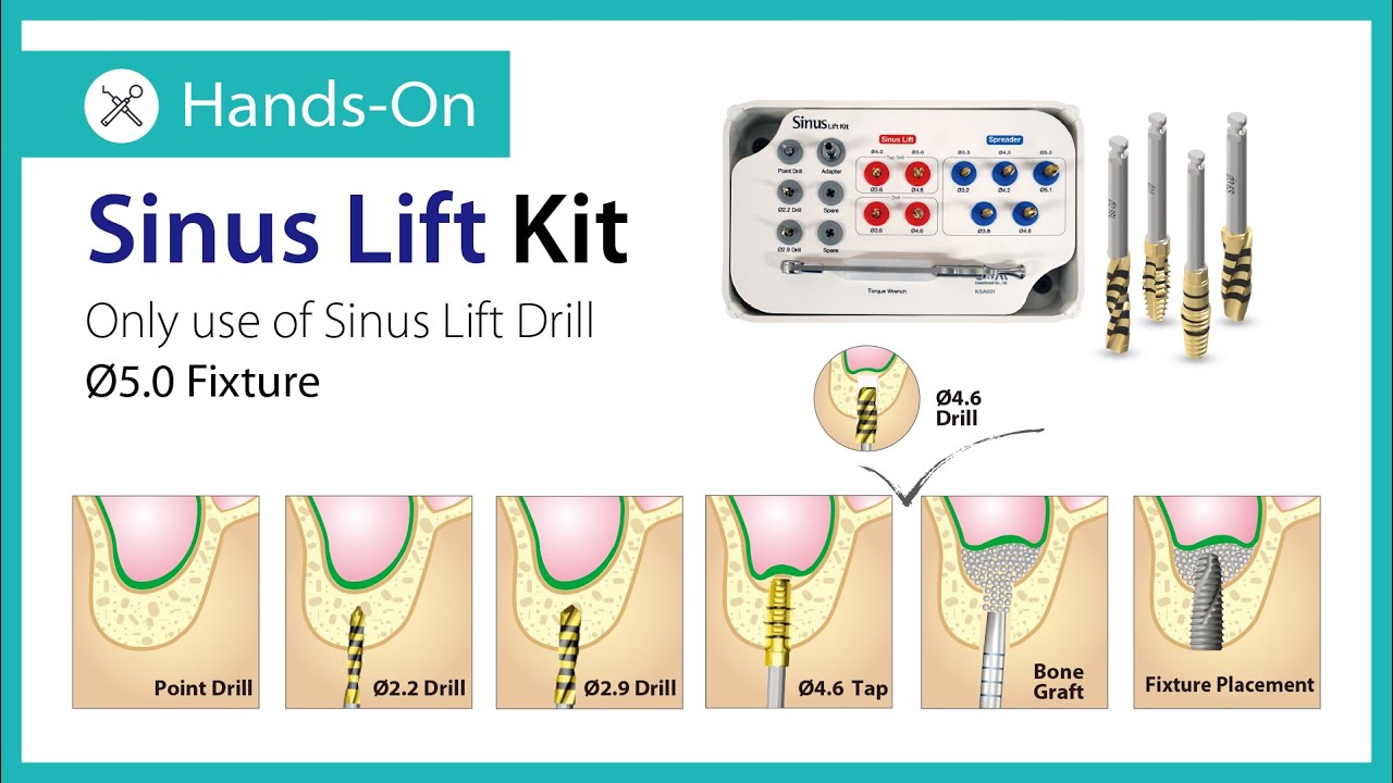 Sinus Lift Kit [Only use of Sinus Lift Drill_(Ø5.0 Fixture)] - YouTube