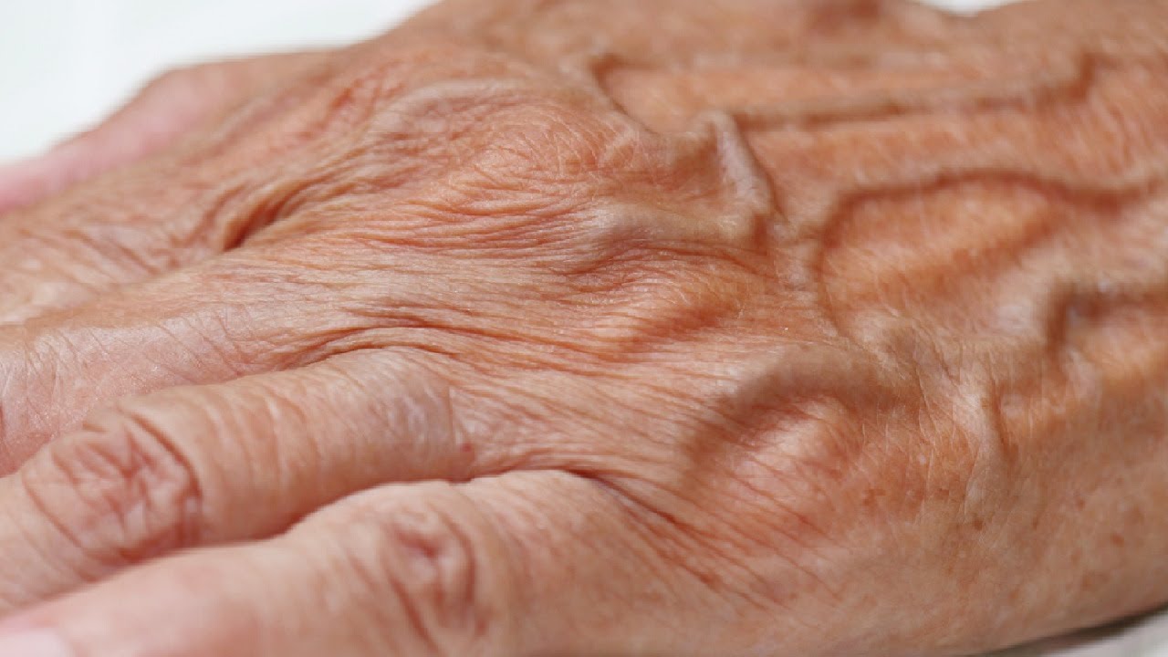 how to get rid of varicose veins on your hands step by step - YouTube