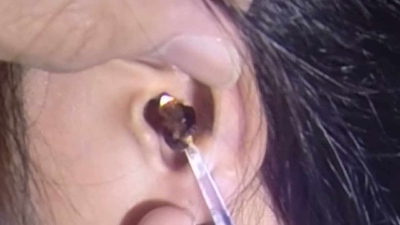 Classic Massive Earwax Removal - YouTube