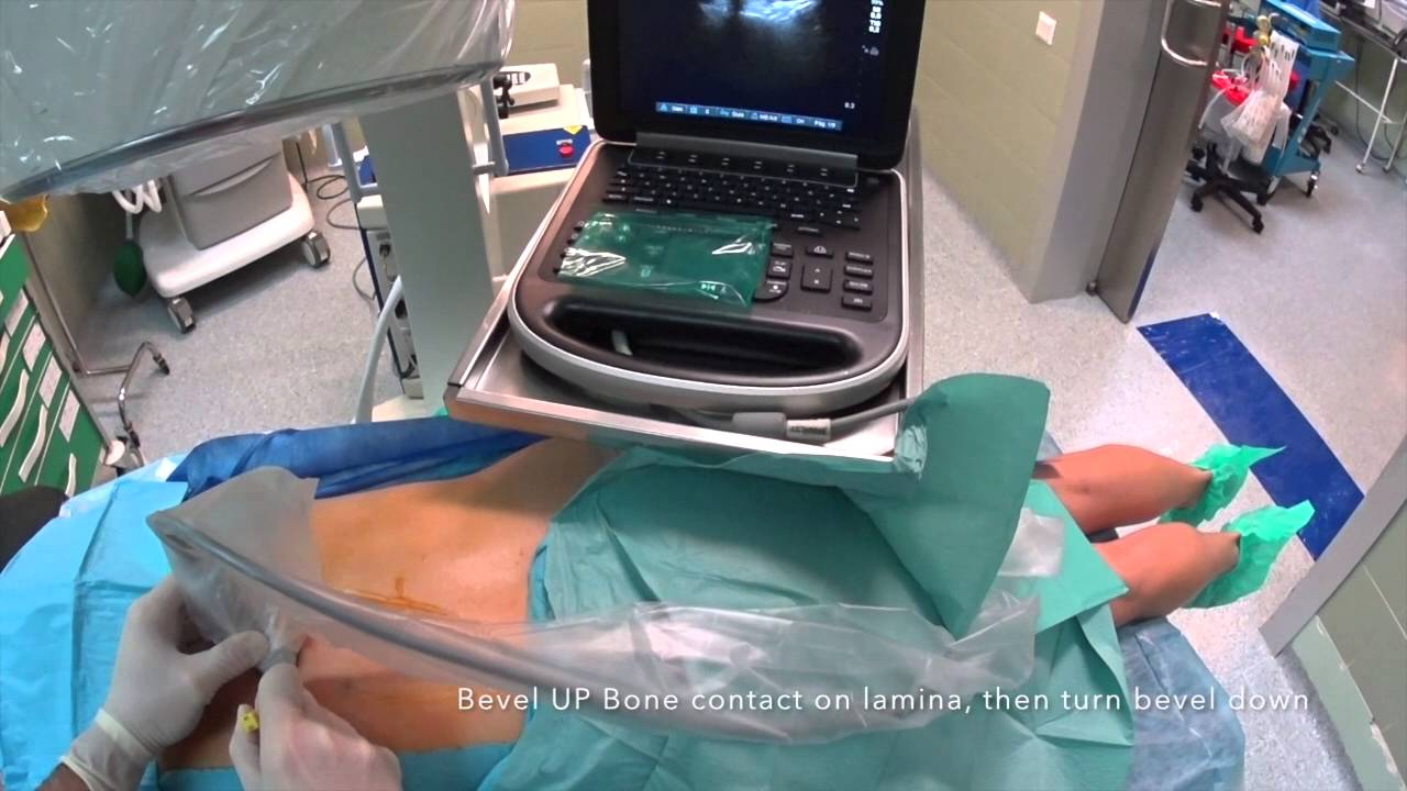 THORACIC T7 DRG Pulsed RF Ultrasound Guided - YouTube